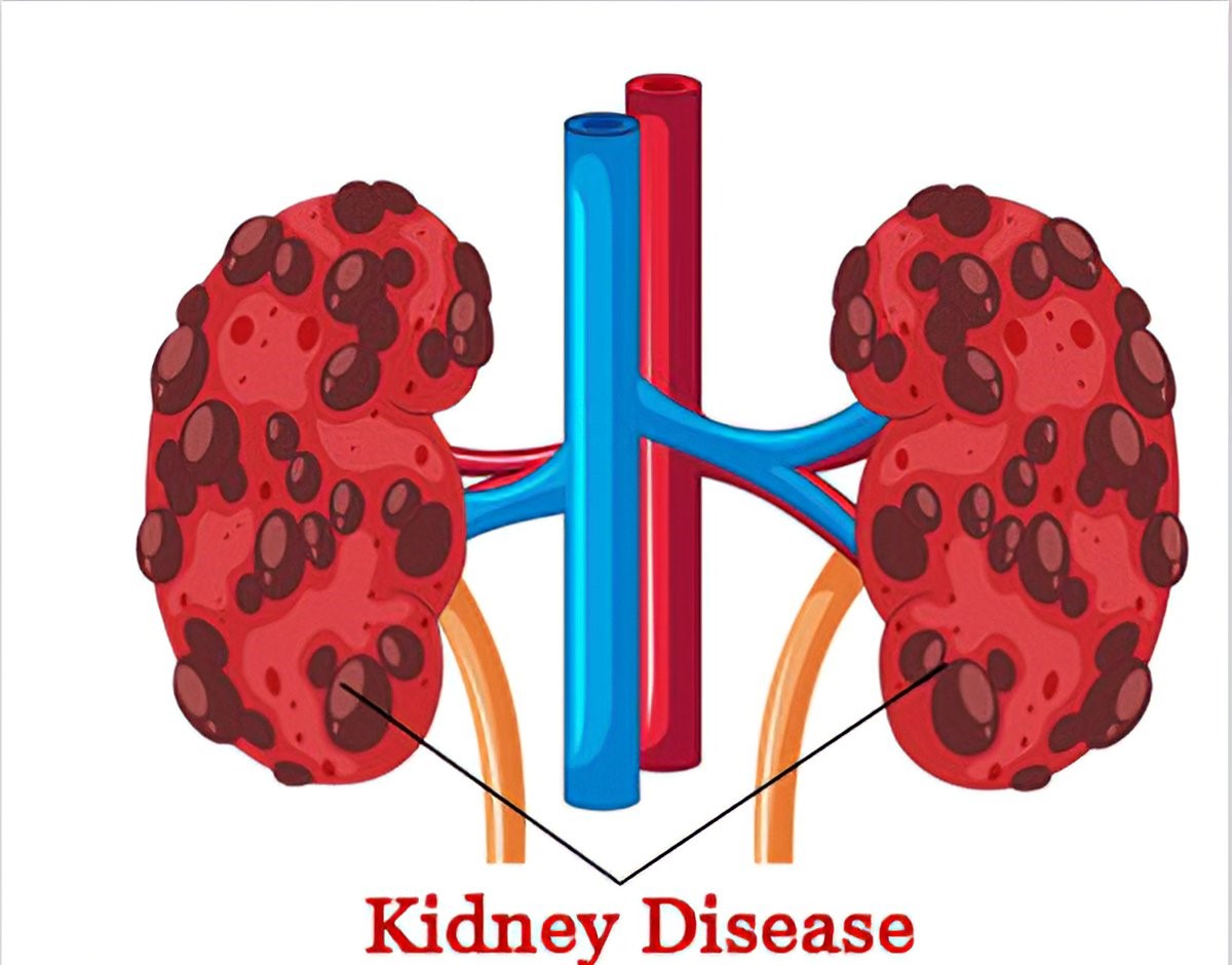 Facts & Myths about Kidneys Diseases - Best Nephrologist and Kidney ...