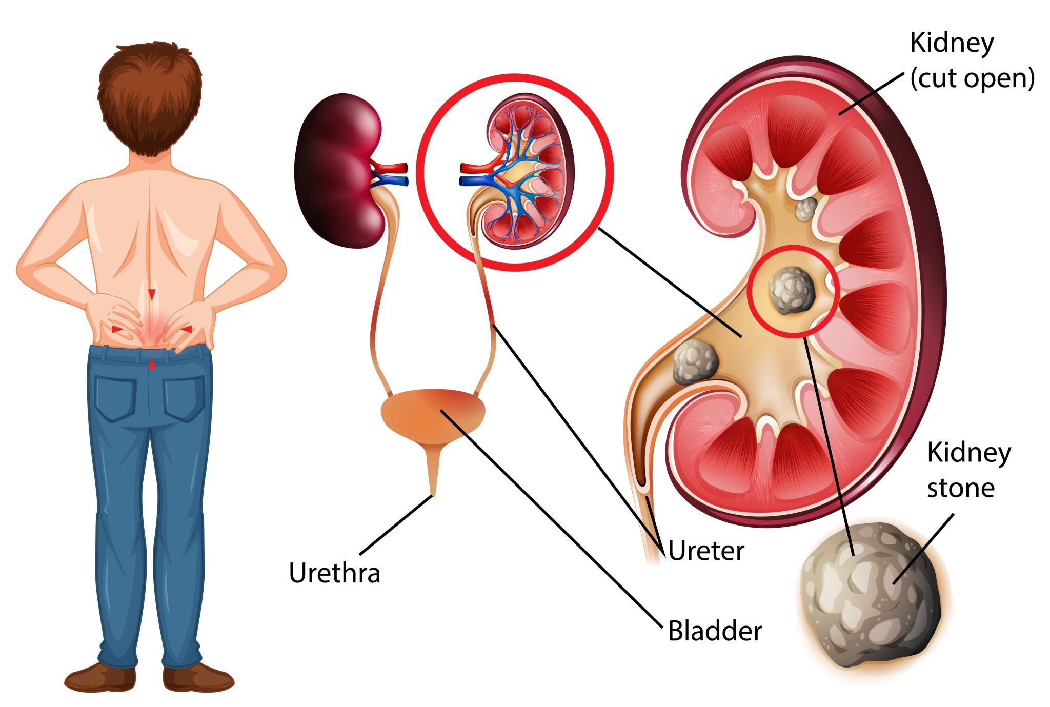 Shrunken Kidneys: Causes, Symptoms, and Solutions - Best Nephrologist ...
